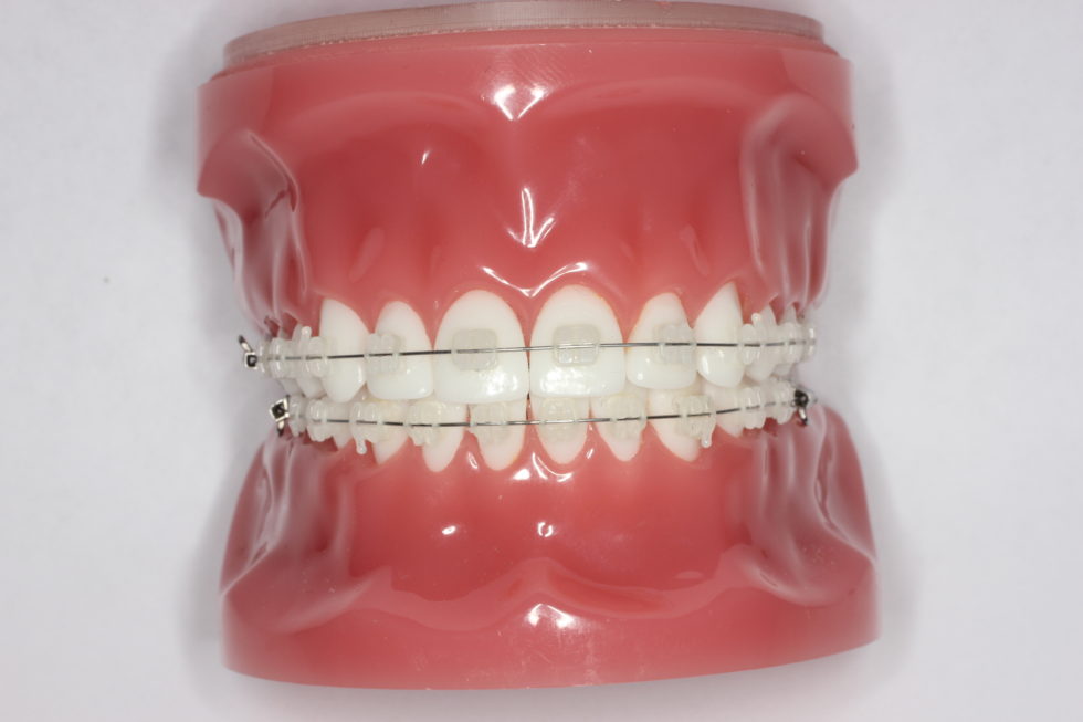 Orthodontic Appliances | Dr Pascal Carrière